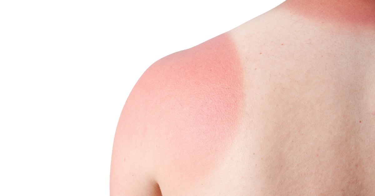 Come capire se una scottatura è grave? - Torrinomedica