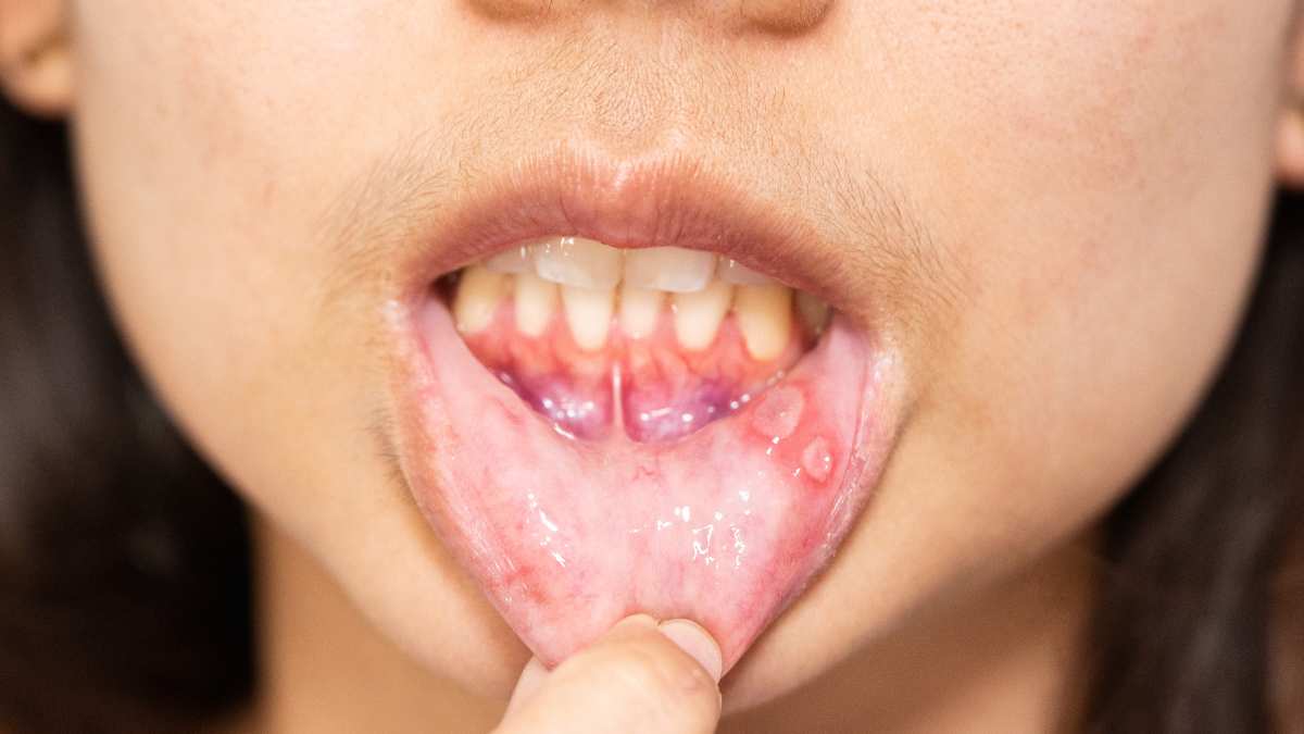 Quali vitamine prendere per le afte in bocca? - Torrinomedica