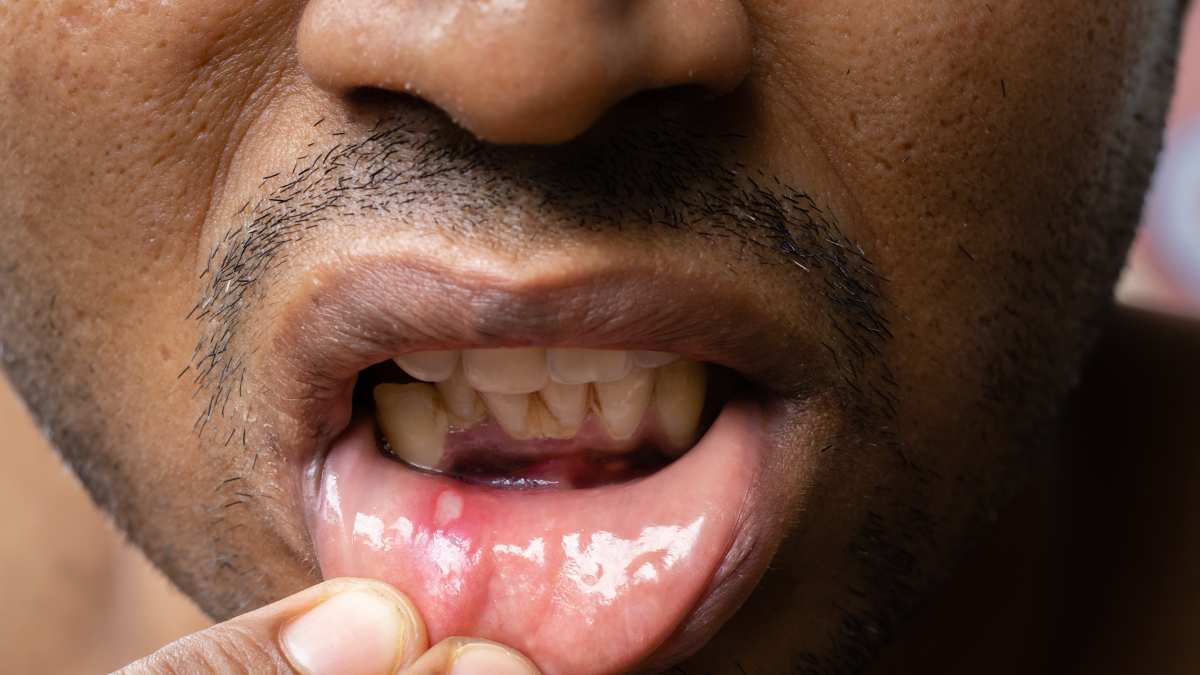 A quale medico rivolgersi per le afte in bocca? - Torrinomedica