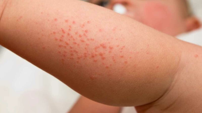 What does a strep rash look like? - Torrinomedica