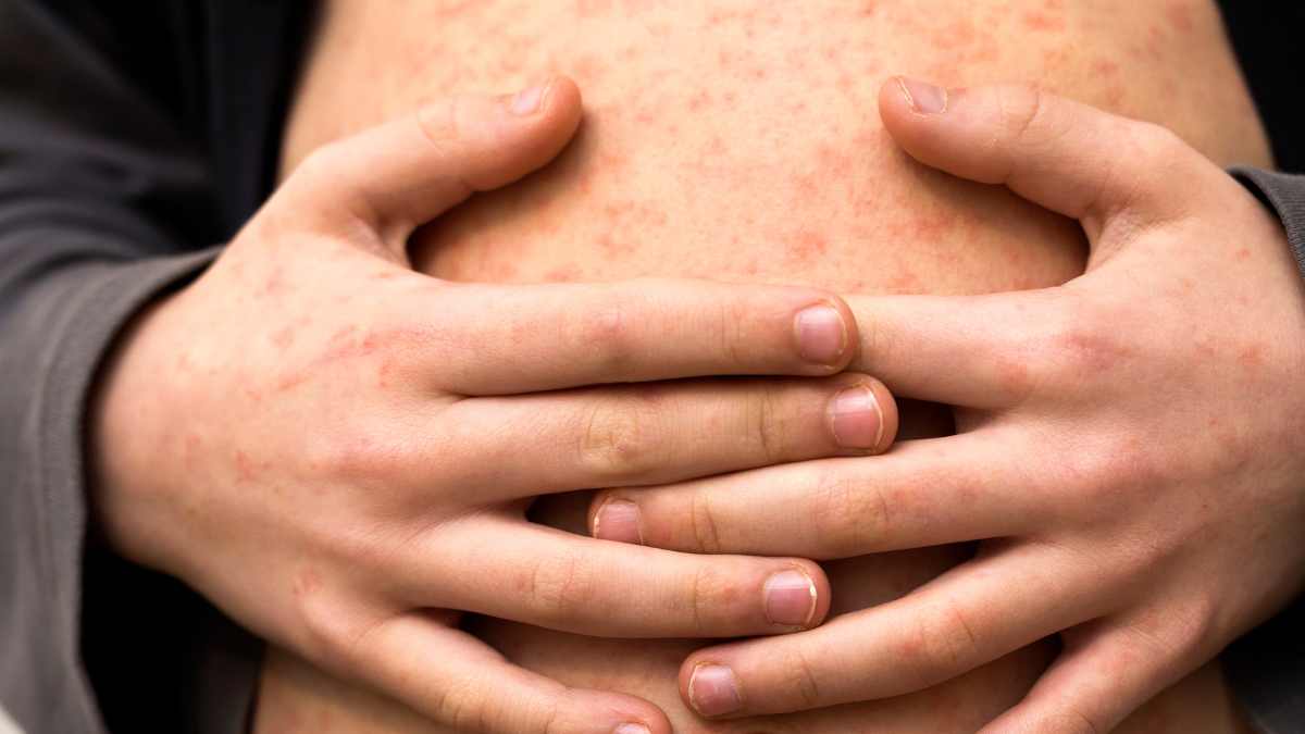 Quanti sono ogni anno i morti in italia per morbillo? - Torrinomedica