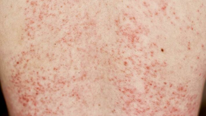 How do you tell if a rash is fungal or bacterial? - Torrinomedica