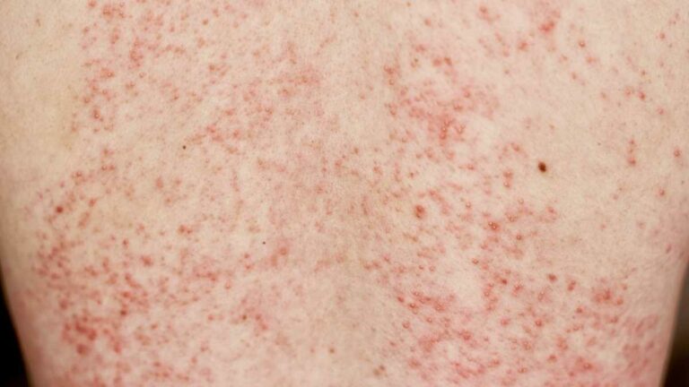 How do you tell if a rash is fungal or bacterial? - Torrinomedica