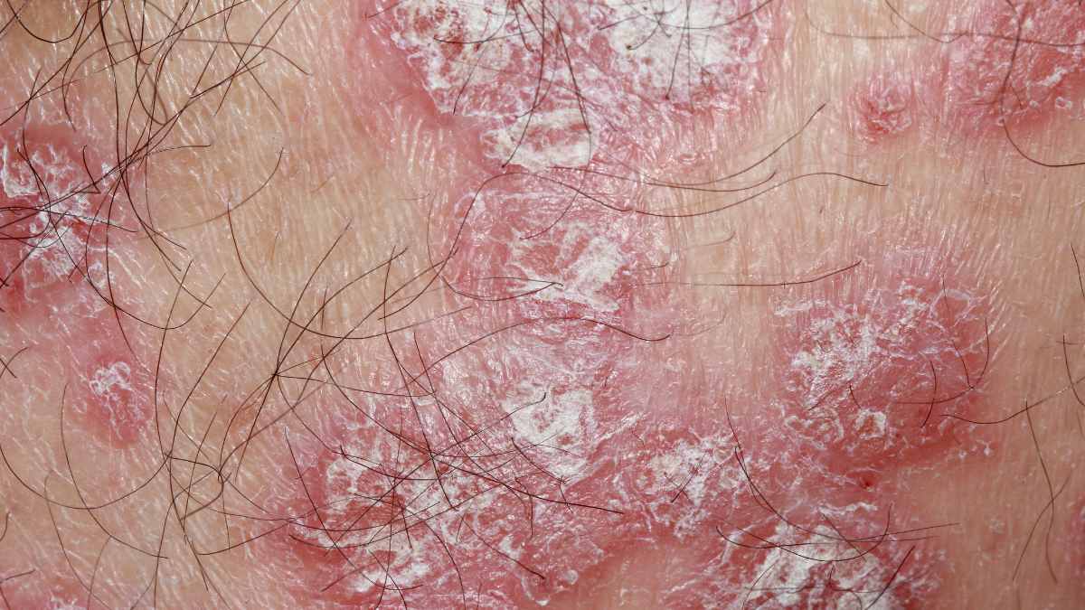 Lichen planus: patologia autoimmune cutanea e terapia - Torrinomedica