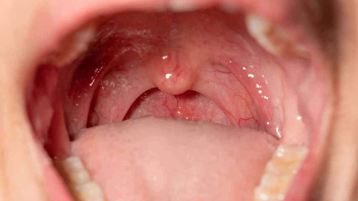 Faringite virale: mal di gola acuto e trattamenti sintomatici ...