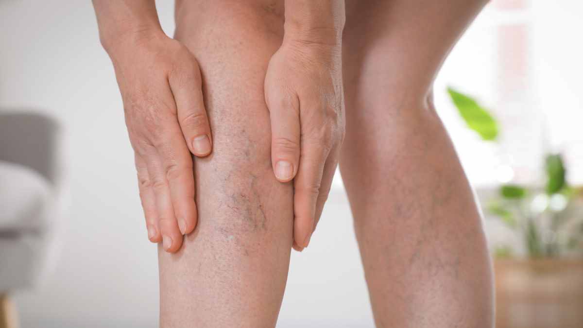 Insufficienza venosa cronica: sintomi e trattamento con Daflon - Torrinomedica