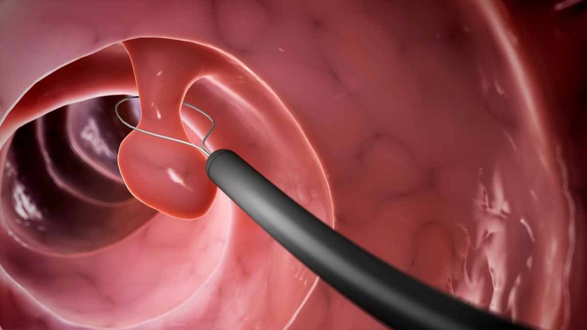 Polipi intestinali: sintomi, screening e rimozione - Torrinomedica